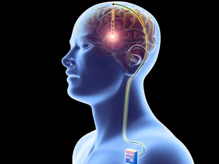 Post-Operative Care After DBS Surgery