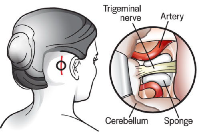 Potential Risks and Complications of Trigeminal Neuralgia Surgery
