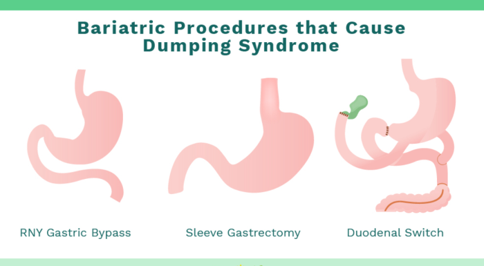 Understanding Dumping Syndrome After Revision Bariatric Surgery