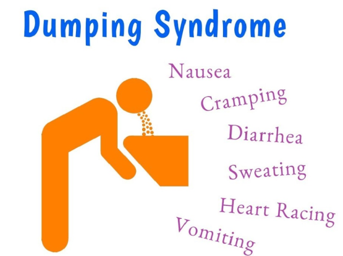Understanding Dumping Syndrome After Revision Bariatric Surgery