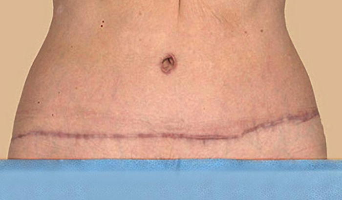Managing Scars After Full Body Lift Surgery