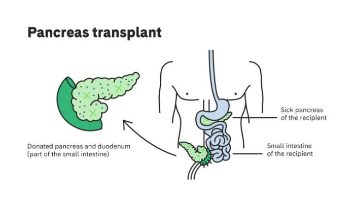 Why Pancreas Transplants Are Critical for End-Stage Diabetes