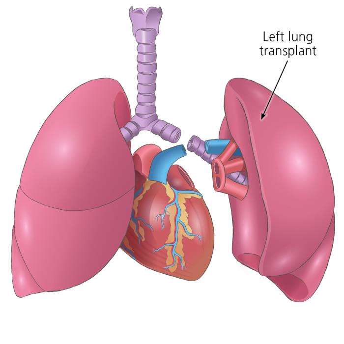 How to Reduce the Risk of Infection After Lung Transplant Surgery