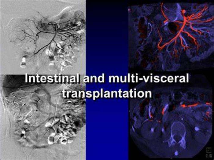 Comparing Small Bowel Transplants and Multivisceral Transplants